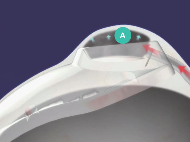 Molteno3® - Molteno